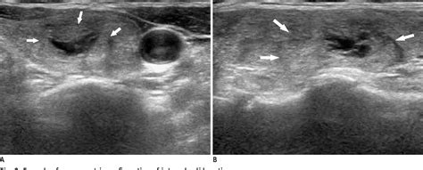 Figure 3 From Partially Cystic Thyroid Nodules Ultrasound Findings Of