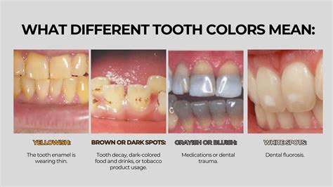 11 Causes Of Tooth Discoloration
