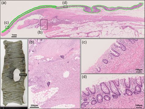 Gross And Histological Findings On Gross Examination A Large