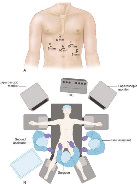 Nissen Fundoplication Abdominal Key