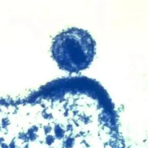 紐約幹細胞移植生效 女愛滋病患「痊癒」年餘病毒基因研究