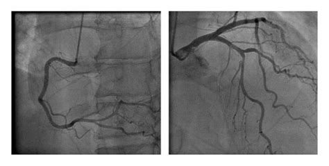 Angiogram Reveals Normal Coronary Arteries Download Scientific Diagram