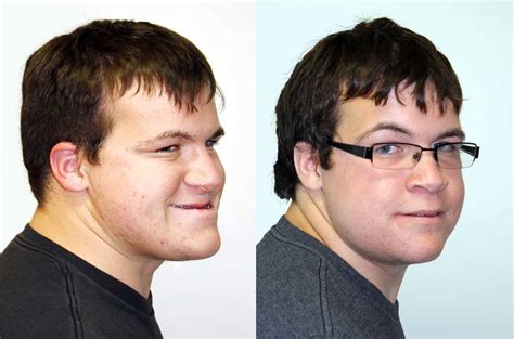 Clockwise Face Rotation And Chin Recontouring Corrective Jaw Surgery