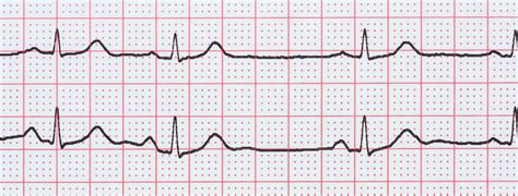 Basic Ecg Arrhythmia Practice Test