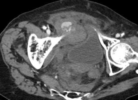 CT Case 097 LITFL CT Scan Interpretation CT Case 097 LITFL CT Scan Interpretation