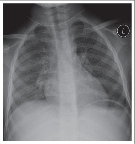 X Ray Chest Tuberculosis