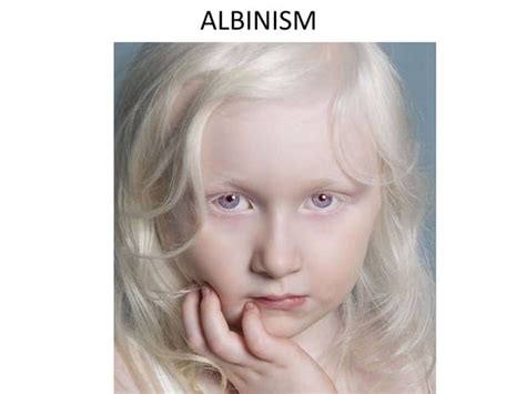 Albinism Eye Problems