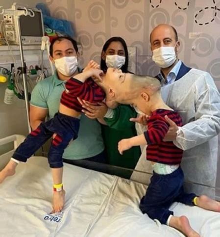 Milagro logran separar a gemelos siameses de 3 años unidos por la cabeza