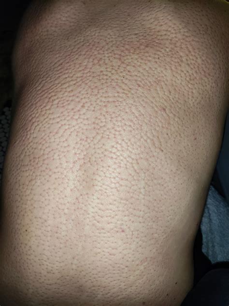 Hooman Back After Laying On A Acupressure Mat R Trypophobia