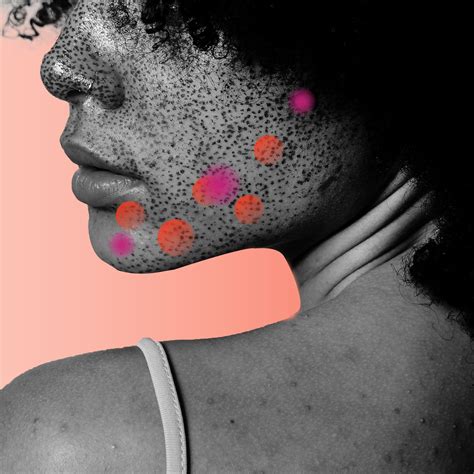 How To Get Rid Of Cystic Acne Once And For All Artofit