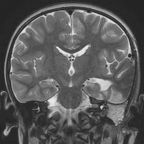 Post Operative Mri Control Shows Complete Excision Of The Mass C