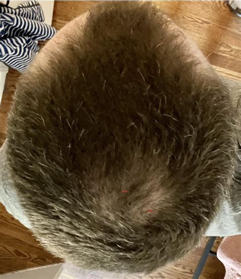 37 Year Old 6 Months Dutasteride 05 And Oral Minoxidil 25 R