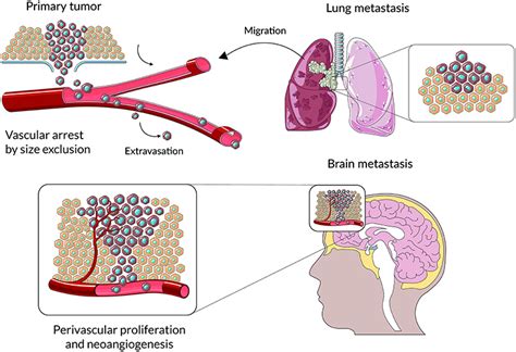 Metastatic Brain Cancer Symptoms