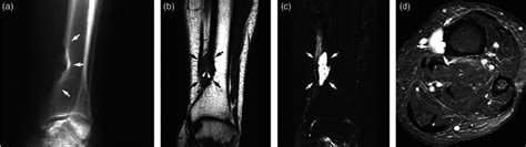 Chondromyxoid Fibroma Of The Distal Tibia In 65 Year Old Woman A Download Scientific Diagram