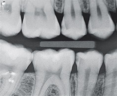 Clinical Case Bulk Fill In Class Ii Proximal Caries 3m Dental Blog
