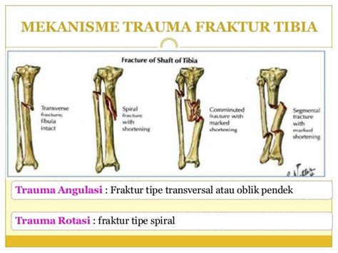 Fraktur Tibia