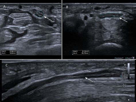 Hand And Wrist Ultrasound London Ultrasound Clinic