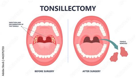 Tonsil Stones Crypts Viral Virus Gland Strep Throat Sore Enlarged Lymph