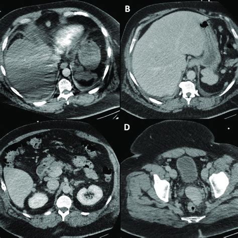 Ct Pulmonary Angiography Arterial Phase Axial Slice A Shows Nodular
