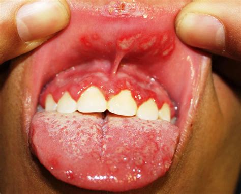 Pictures Of Angular Stomatitis Symptoms And Pictures