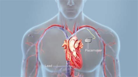 Laser Lead Extraction Phoenix Az And Tempe Az Arizona Heart