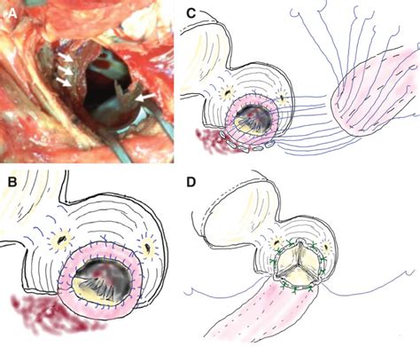 Aortic Valve Replacement With Annular Patch Reconstruction For