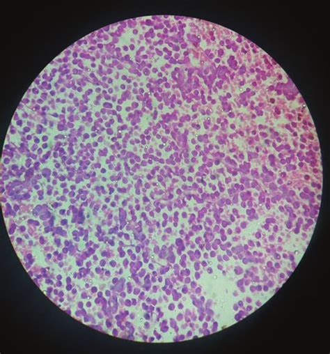 Histopathology Image Showing Acth Secreting Pituitary Adenoma