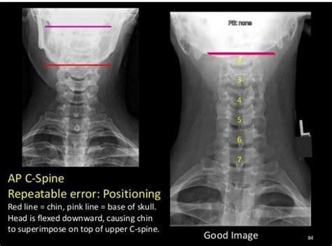 Ap C Spine Image Radiology Medical Radiography Diagnostic Imaging