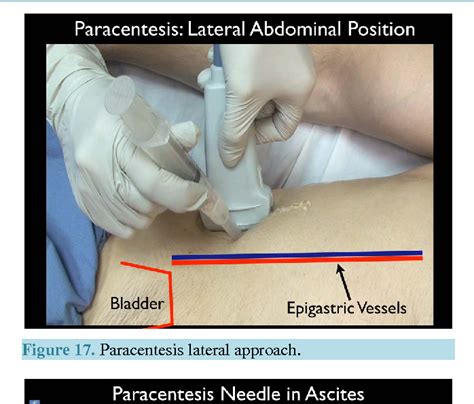 Paracentesis Procedure