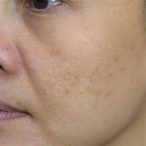 A Speckled And Lentiginous Nevus On Left Side Of The Face In A 17 Year