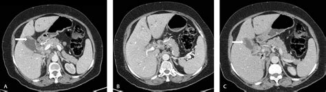 Lymph Nodal Metastatic Pattern In Carcinoma Gallbladder With Multidetector Computed Tomography