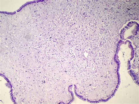 Fibroepithelial Polyp Histology