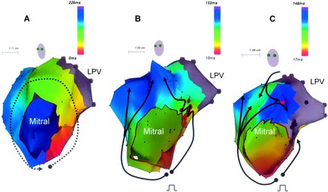 Technique And Results Of Linear Ablation At The Mitral Isthmus