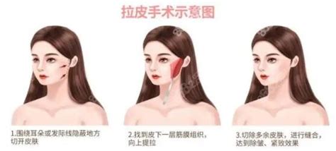 都是面部提升好的医生，黄寅守和袁强做拉皮手术谁更好些除皱对比照 8682整形网