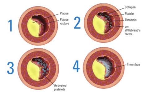Myocardial Infarction Patho Final Flashcards Quizlet
