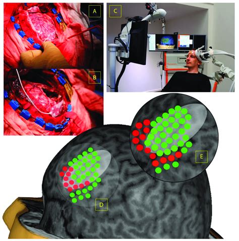 Illustrative Example Of Neuromodulation Induced Cortical Download