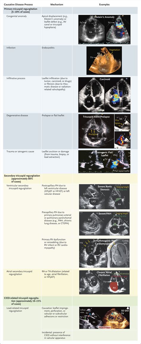 Tricuspid Regurgitation Nejm