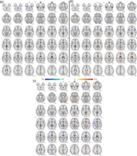 Voxel‐based Diktiometry Post‐registration A And Pre‐registration