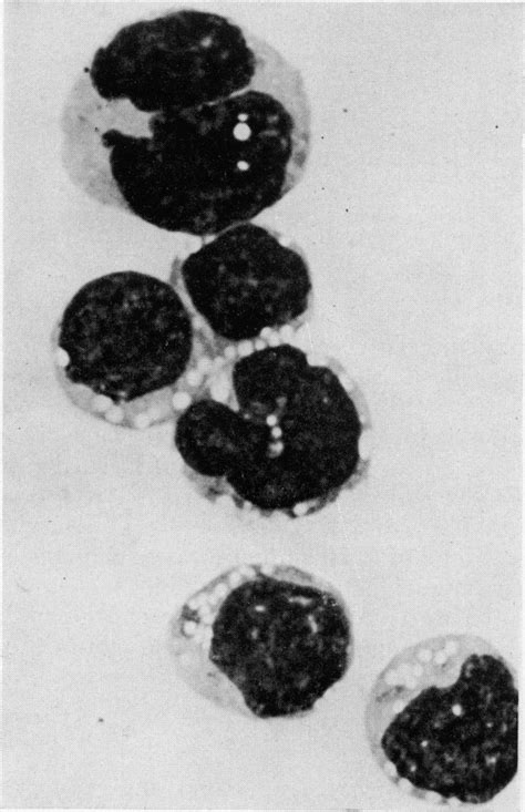 Mgg Stained Cells Showing Mononuclear Cells Two With Cleave D Nuclei Download Scientific