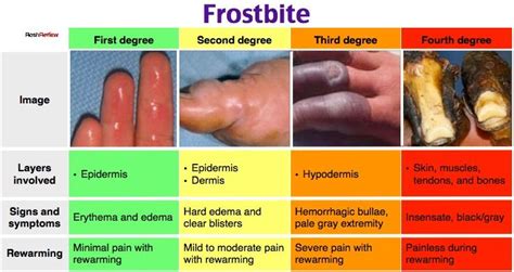 Frostbite Emergency Medicine Medical Mnemonics Nursing Tips