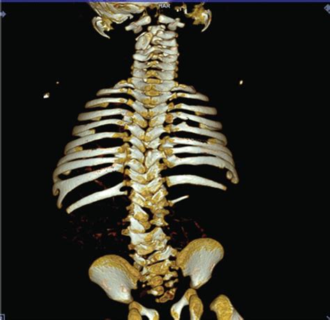 Computed Tomography And X Ray Imaging Of The Scd3 Proband A