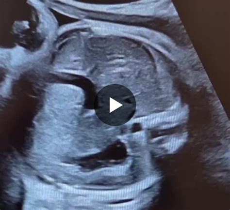 Persistent Right Umbilical Vein Pruv Is Characterized By Atresia Of