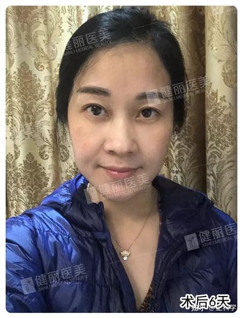 32岁，眼袋和泪沟已有5年了，该如何去除？ 知乎