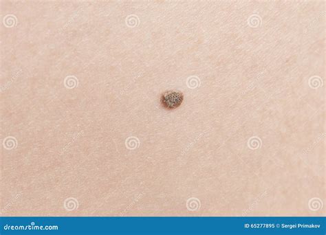 Carcinoma A Cellule Squamose Di Keratinizing Della Pelle Immagine Stock
