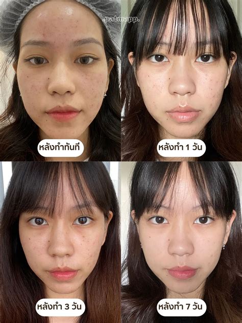 รีวิวเมโสกันตัวดัง👀🧤 จากใจ คนเป็นสิว รอยสิวเยอะ⭐️รอดมั้ย⁉️ แกลเลอรีที่โพสต์โดย Patmapp Lemon8