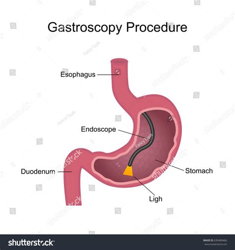 Gastroscopy Procedure Examination Esophagus Stomach Duodenum Stock Gastroscopy Procedure Examination Esophagus Stomach Duodenum Stock