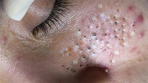 Extreme Blackhead Removal At Lng Skin Care 016 Youtube