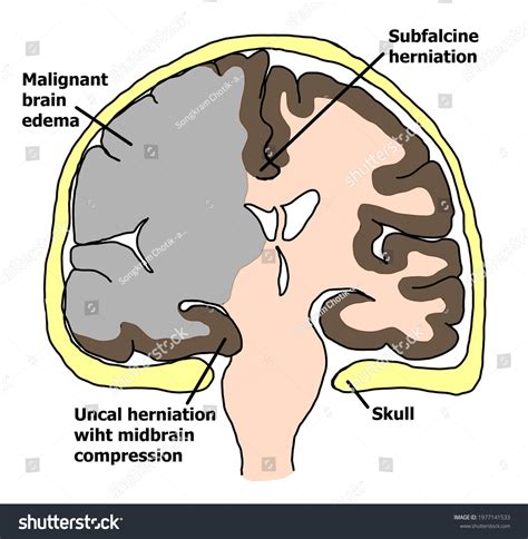 Brain Swell Images Stock Photos Vectors Shutterstock