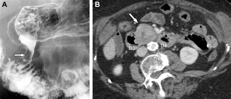 Fluoroscopic Evaluation Of Duodenal Diseases Radiographics