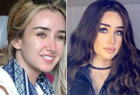 هنا الزاهد قبل عملية التجميل وبعدها